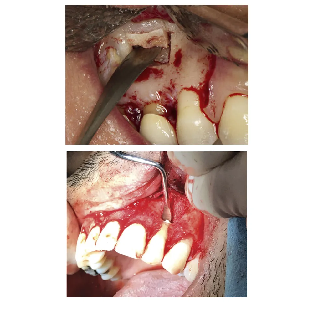 Buy GDC Endo Surgical S/13 Kit with Cassette Online | Dentalkart