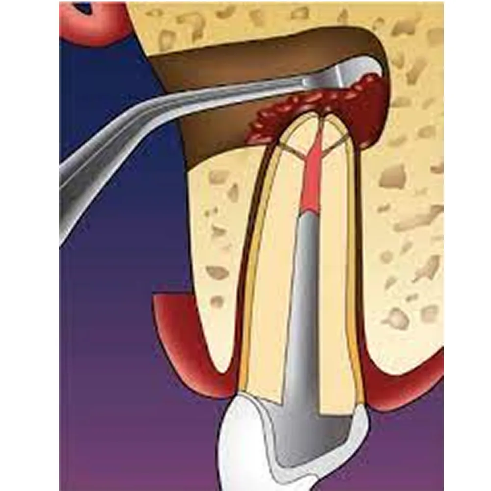 Buy GDC Endo Surgical S/13 Kit with Cassette Online | Dentalkart