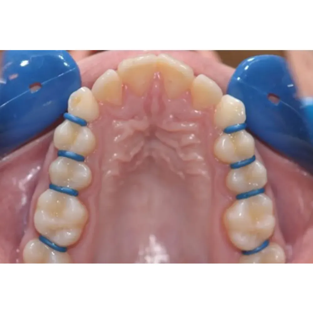 Koden Othro Elastic Separators (Pack of 1000) Online at Best Price ...