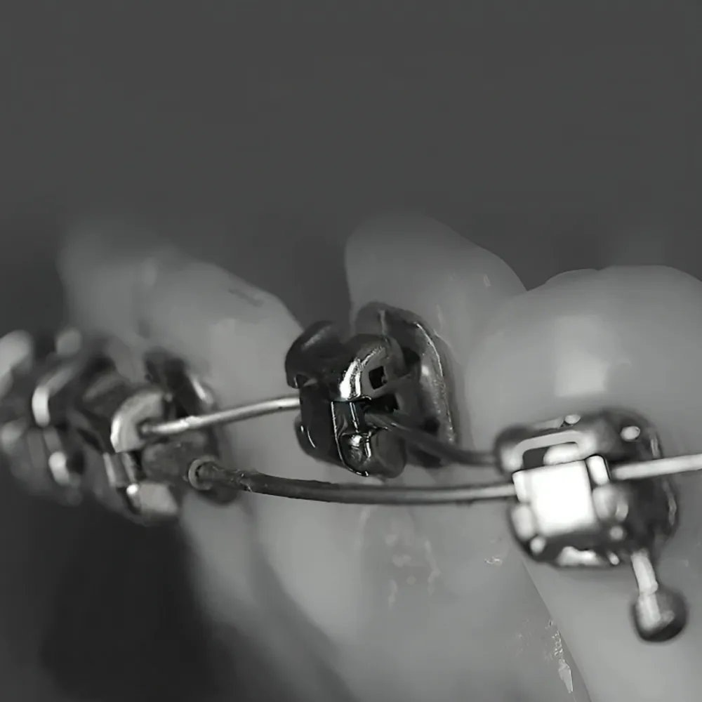 Koden EZ Lock + MBT Metal3 Sets of Cu NiTi Archwires