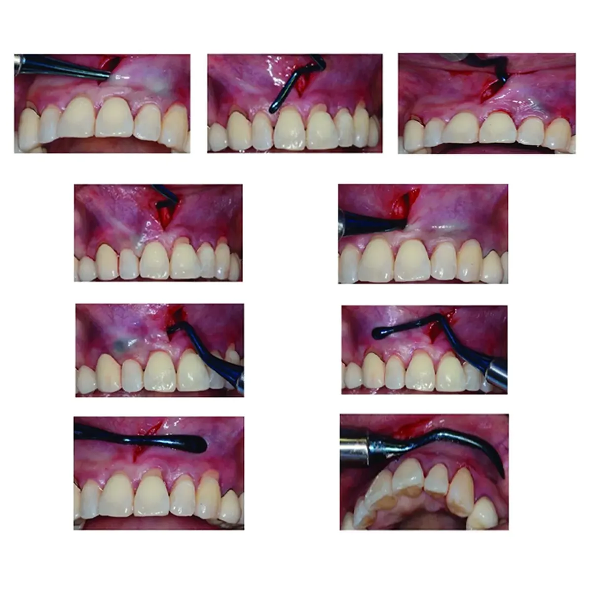 Buy Vista Tunneling Instruments Online | Periodontal Root Coverage ...