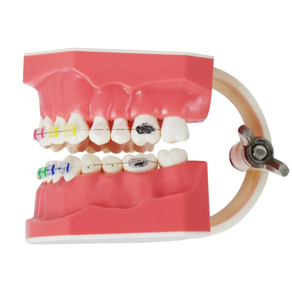 iDENTical Orthodontic Patient Education Model (Ceramic) - M3002 | Get ...