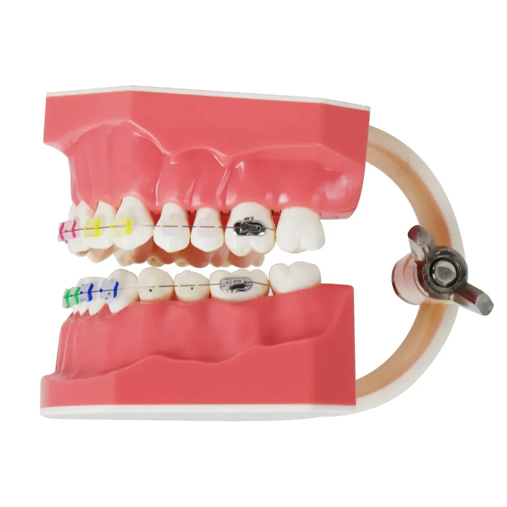 iDENTical Orthodontic Patient Education Model (Ceramic) - M3002 | Get ...