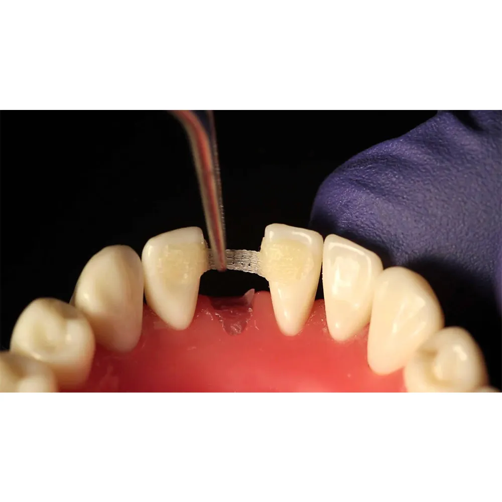 Buy Ammdent Infibra Fiber Splint in best Price Online | DentalKart