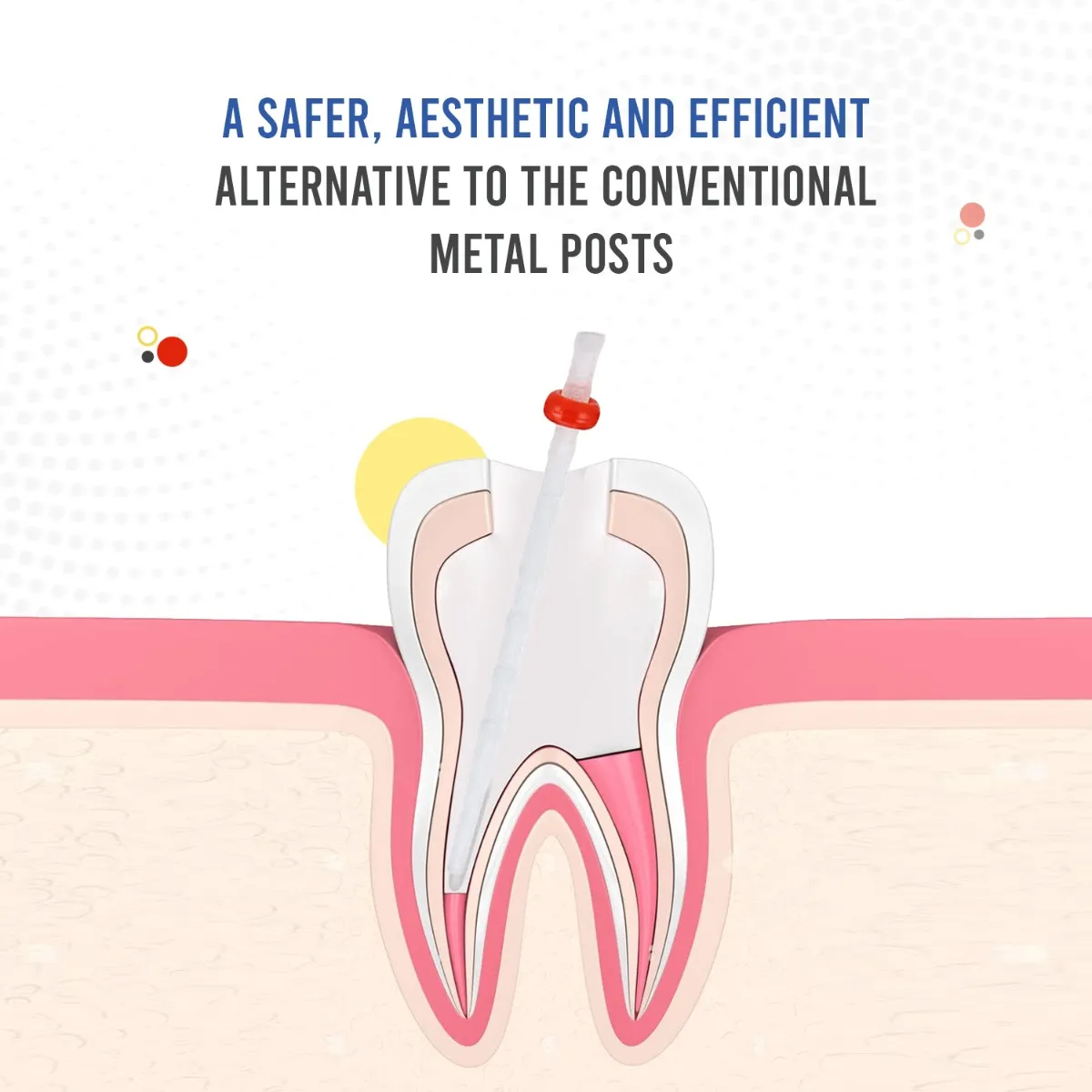 Buy EndoKing Fiber Post Refills - Sizes, Prices & More At Best Prize ...