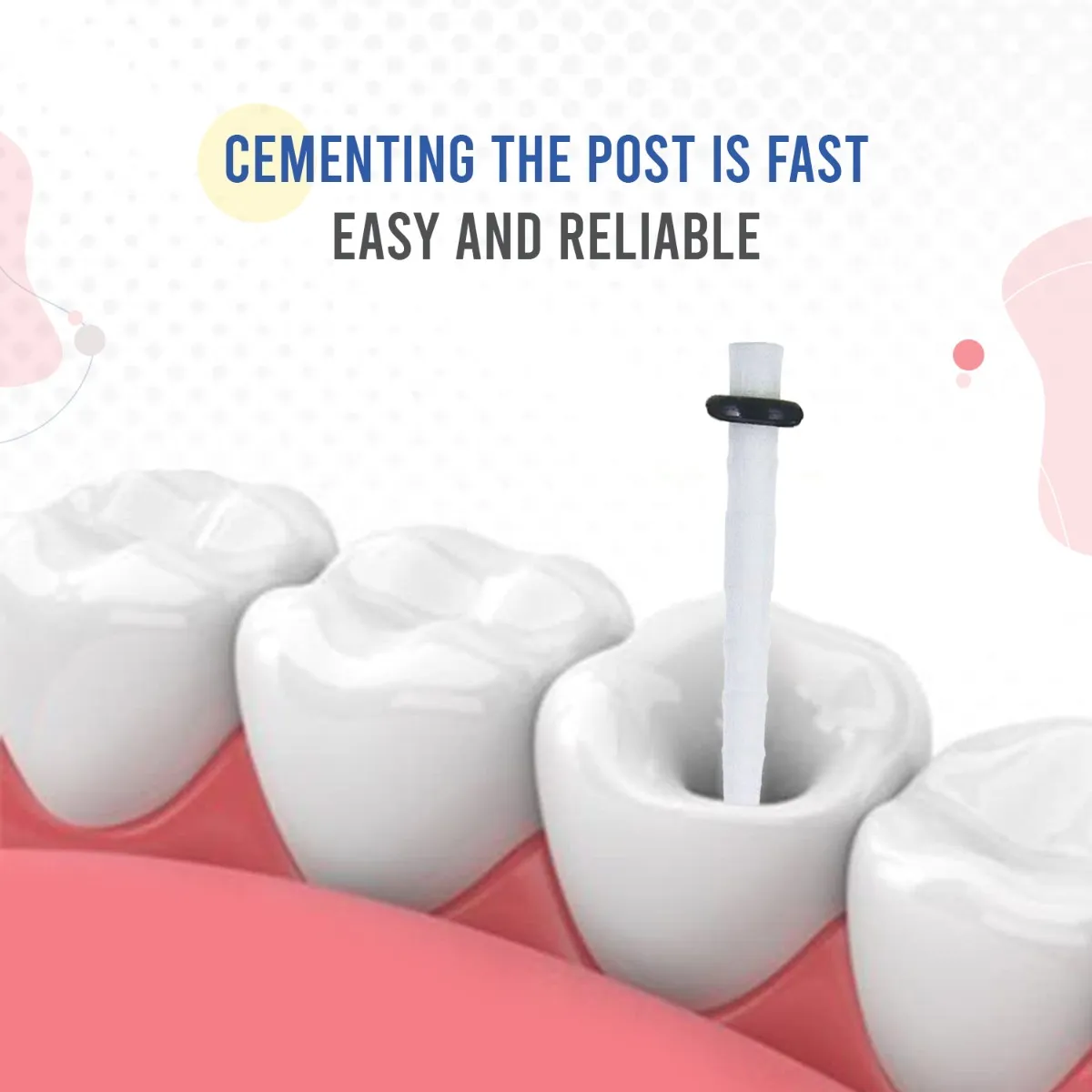 Buy EndoKing Fiber Post Refills - Sizes, Prices & More At Best Prize ...