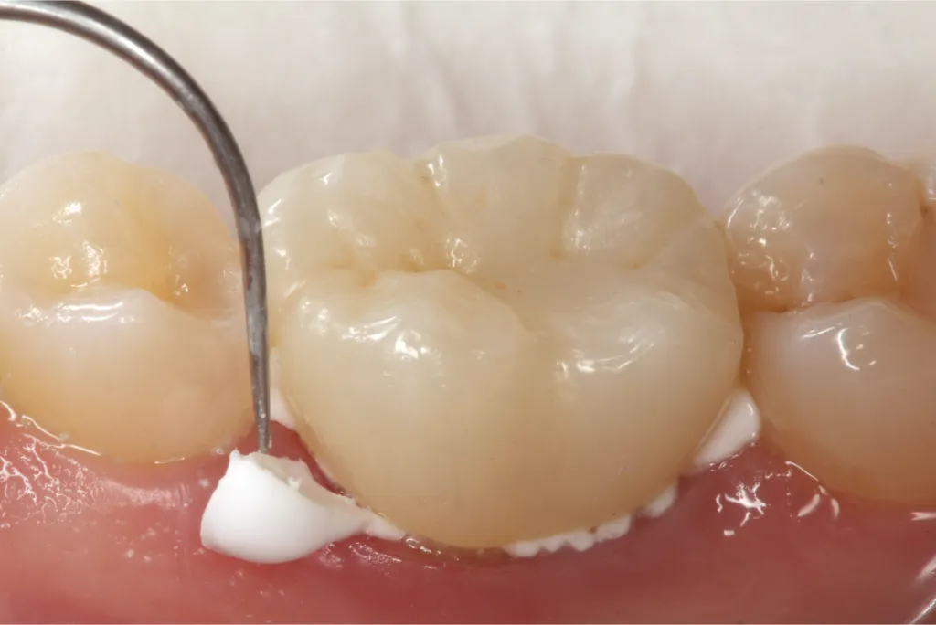 Prevest Crysta GIC Luting I | Dentalkart