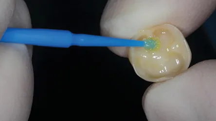 EiTi Applicator Tip - Regular