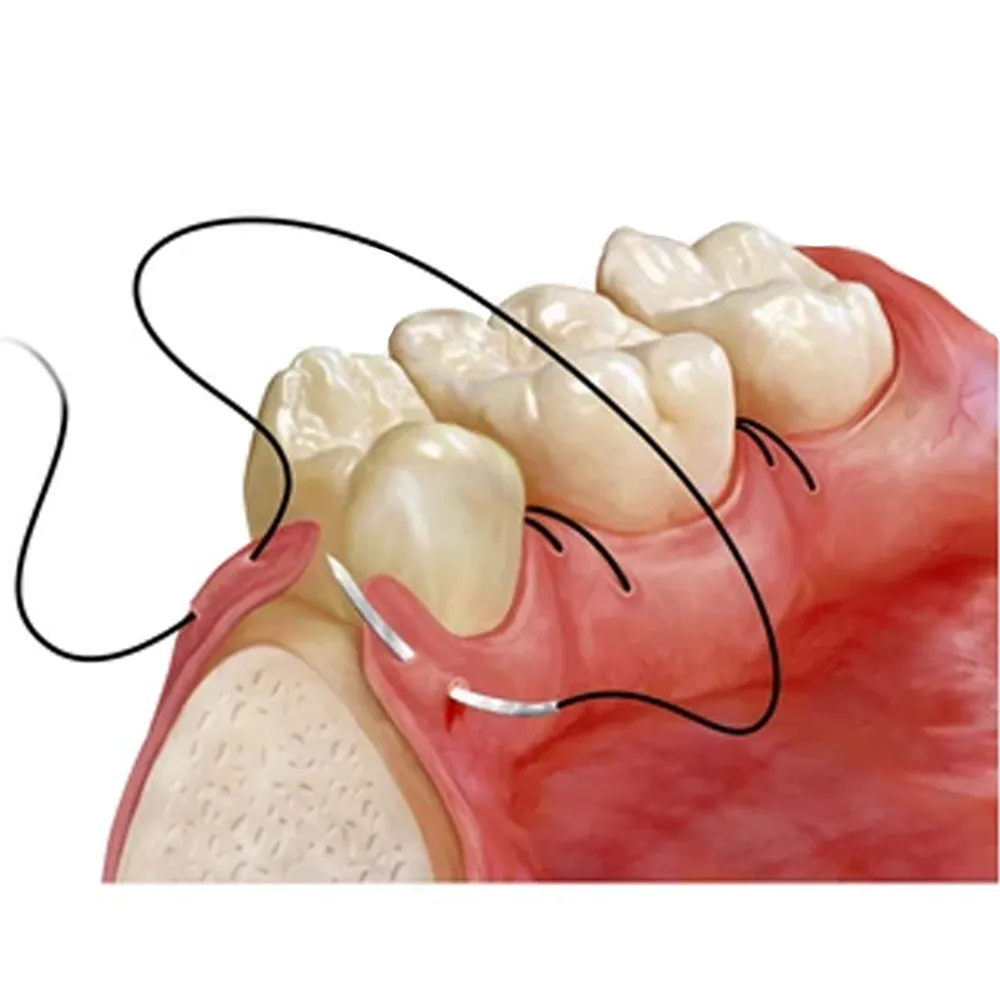 Meril Filasilk #4-0 Black Braided Silk Suture