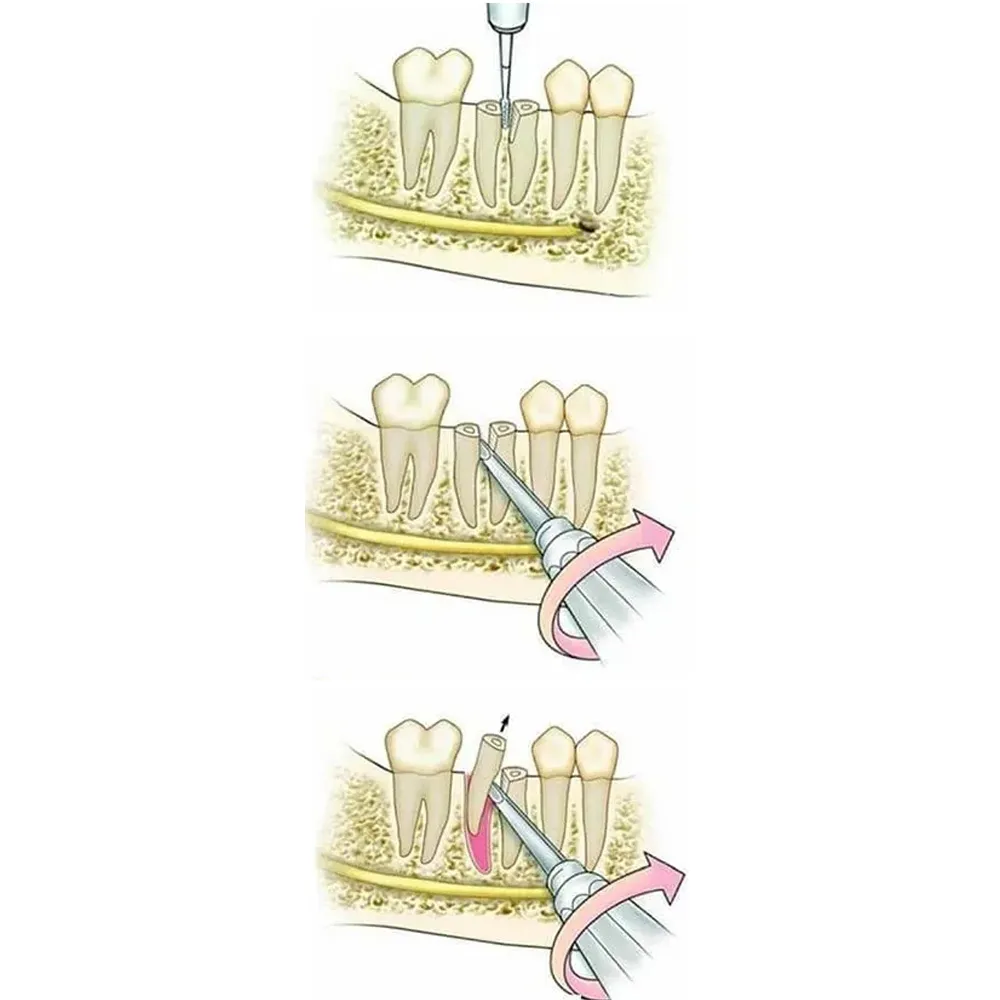Medesy Straight Root Elevators