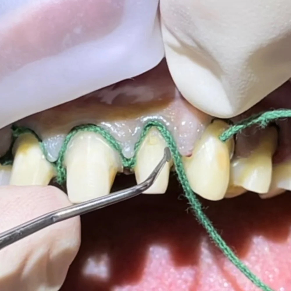 GDC Gingival Cord Packer - Serrated #4 (Hollow Ring Handle)