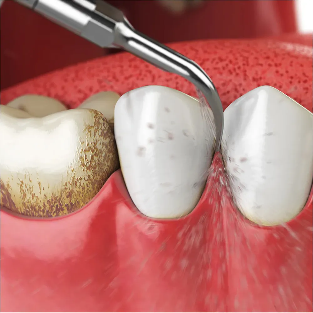 Buy Woodpecker Scaler Tips GD4 for DTE & Satelec Scalers | Dentalkart