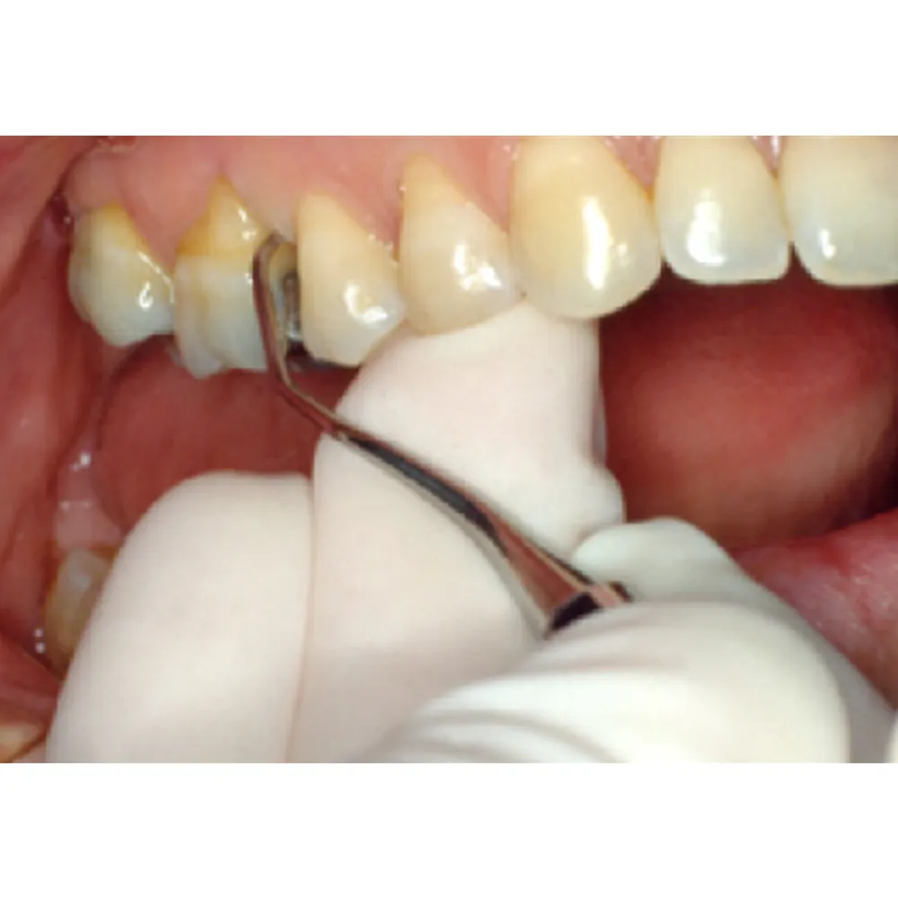 Waldent Gracey Curettes