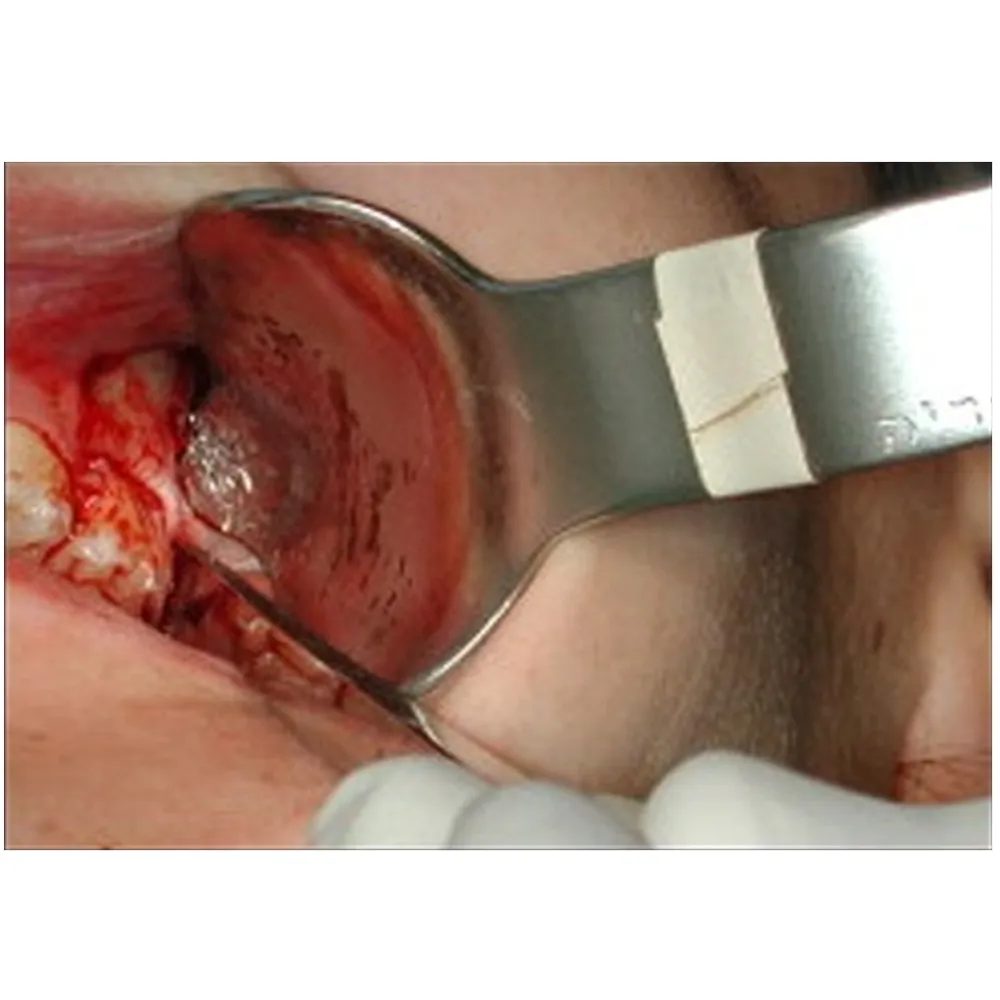 Buy Julldent Laster 3rd Molar Retractor Online At Best Price On Dentalkart