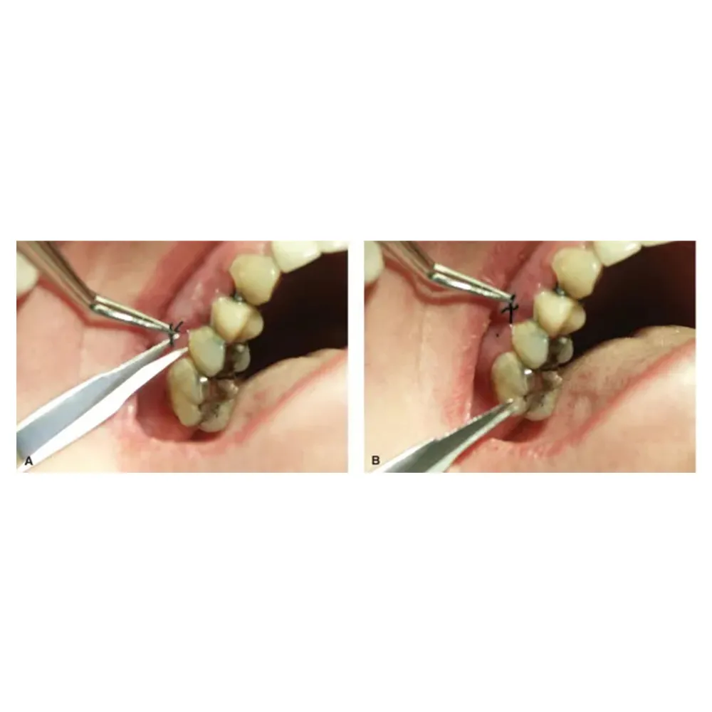 Buy High-Grade Goldman Fox Scissors Online | Dentalkart.com