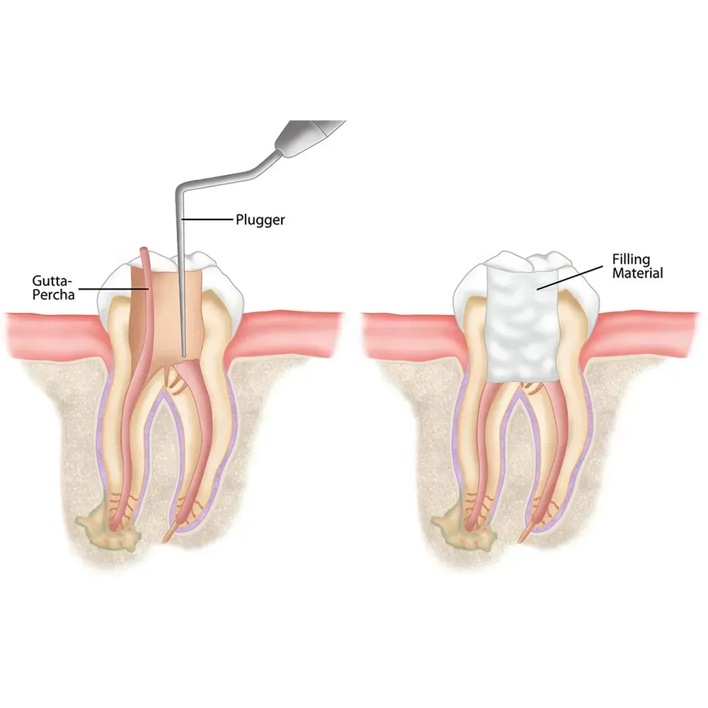 GDC NiTi Hand Pluggers For Root Canal Obturation