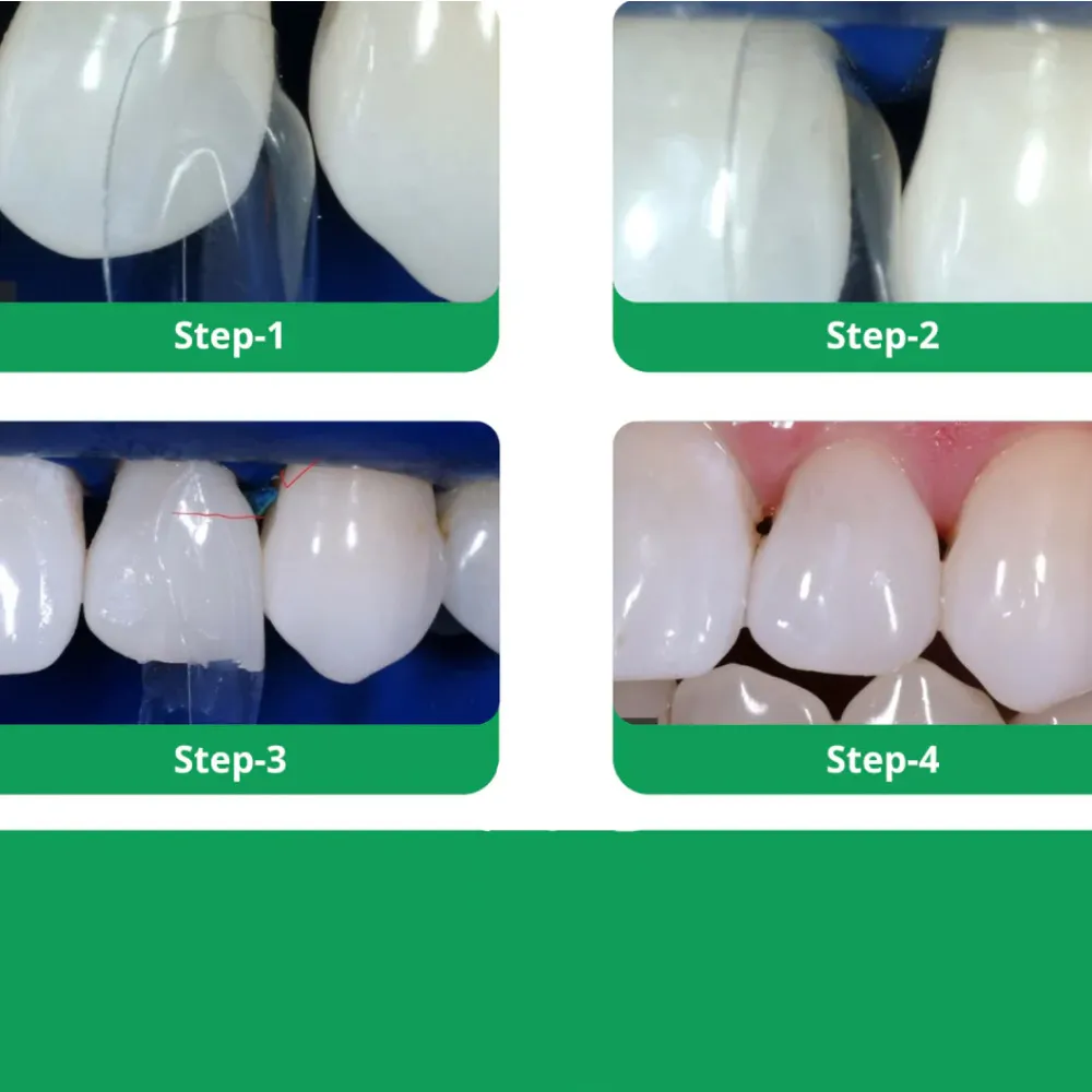 Bioclear Diastema HD Matrix Closure Series