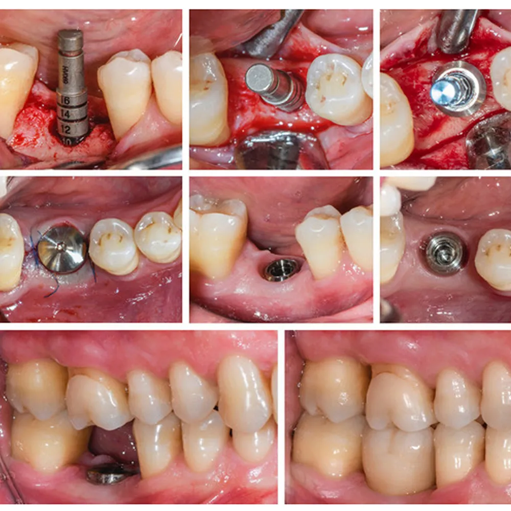 Xcem Dental Implant Mini Submerged Healing Abutment