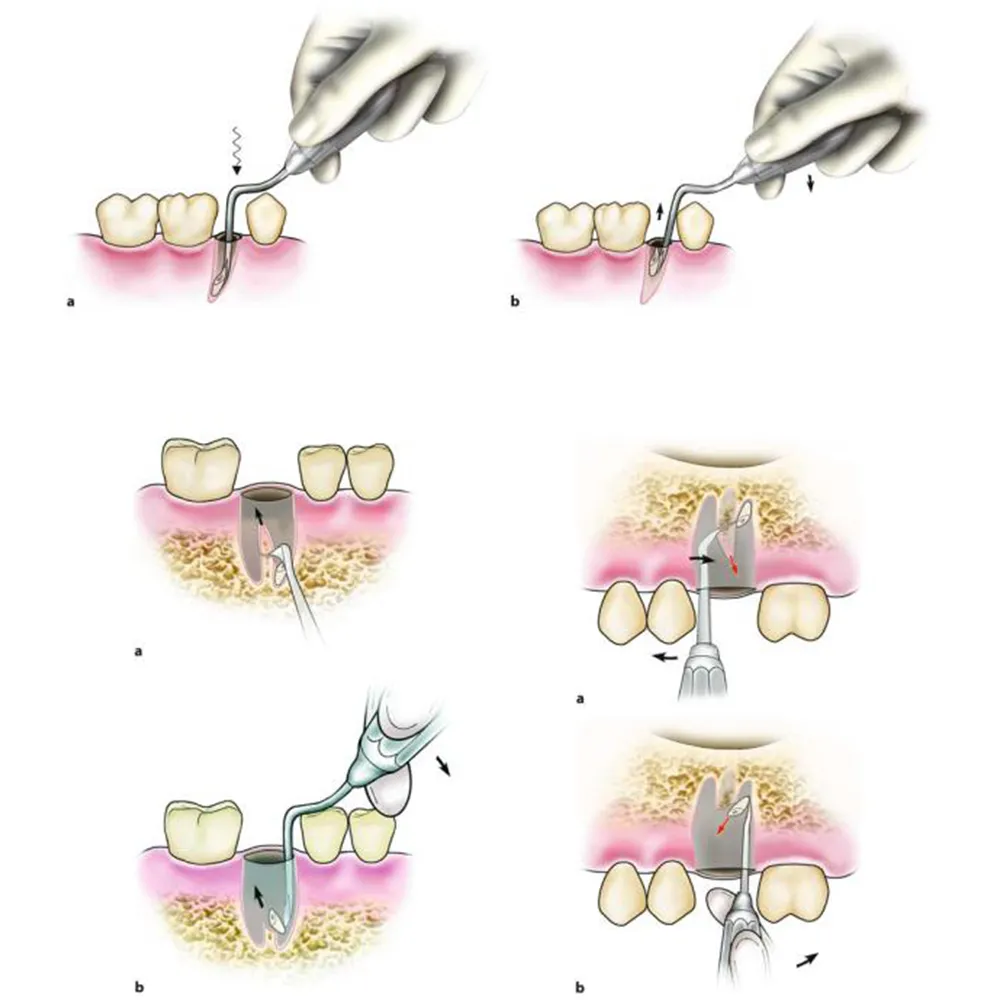 Oracraft Heidbrink Root Elevator And Root Tips Online at Best Price ...