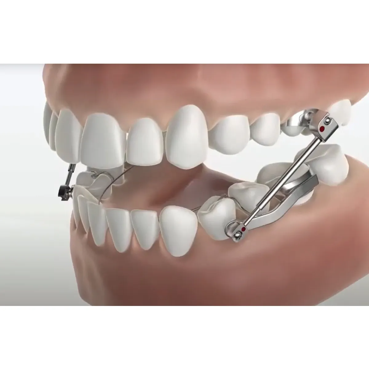 TP Ortho Flip-Lock Herbst Appliance - 610-400 Online at Best Price ...