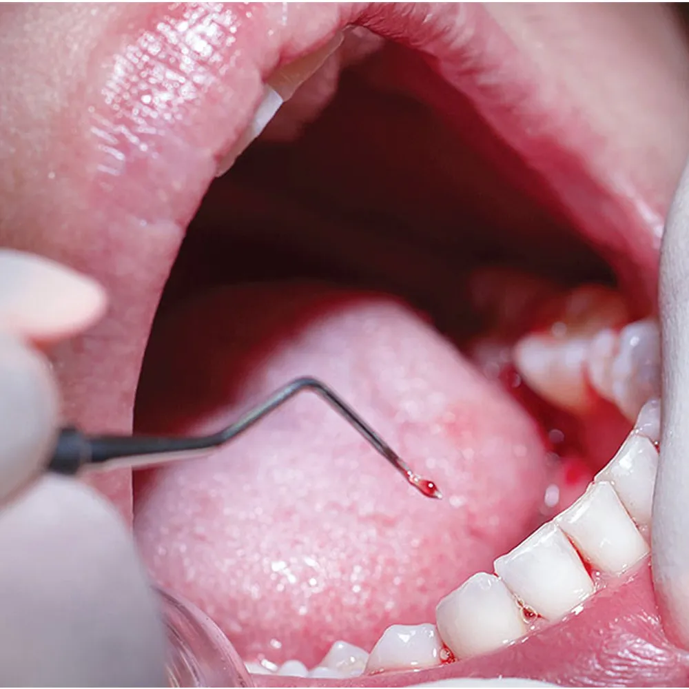 Buy Hirschfeld File Online | GDC Periodontal Curette for Effective ...