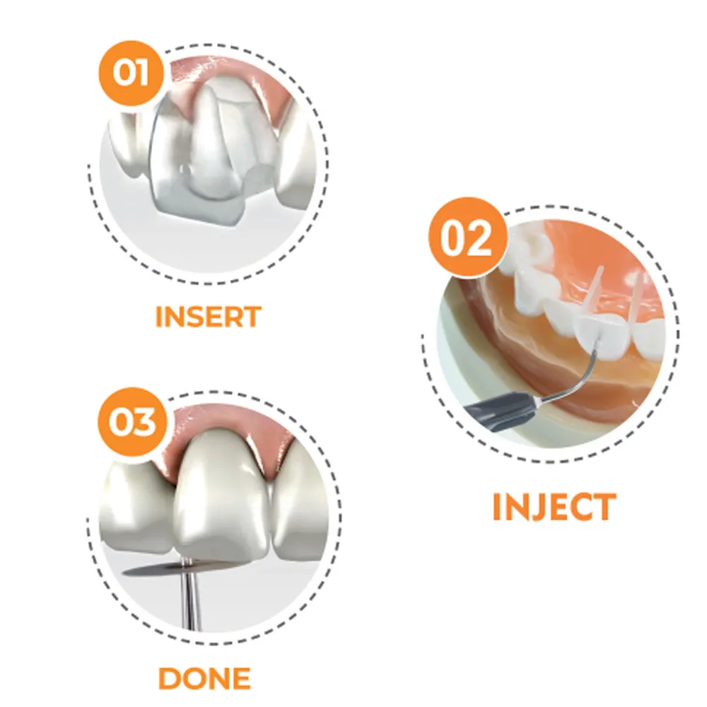 Younique IVeneer Injectable Matrix System