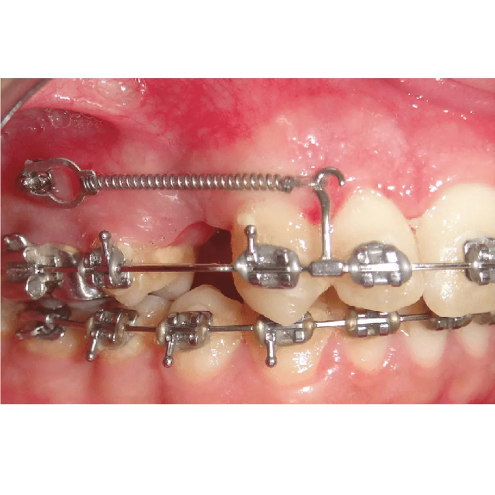 Best Dental Hooks | Ortho Direct Crimpable Hooks Online - Dentalkart