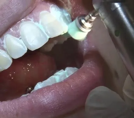 Rubydent RubyShine Prophylaxis Paste (Short Expiry 02-2026)