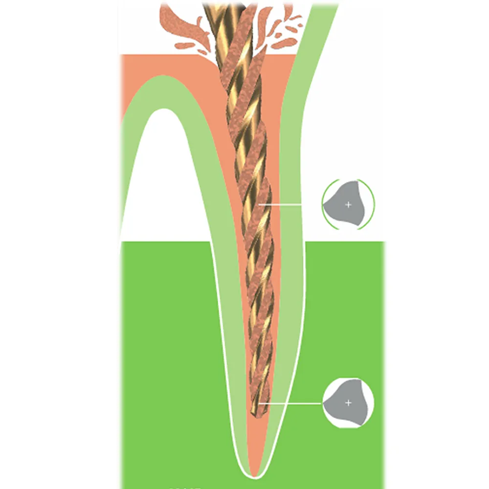 Coltene Hyflex Remover Retreatment Rotary Files | Gutta-Percha Removal ...