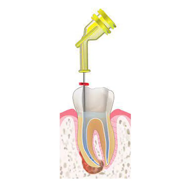 Ultradent NaviTip 30 Gauge with Double Sideport Irrigator Tip