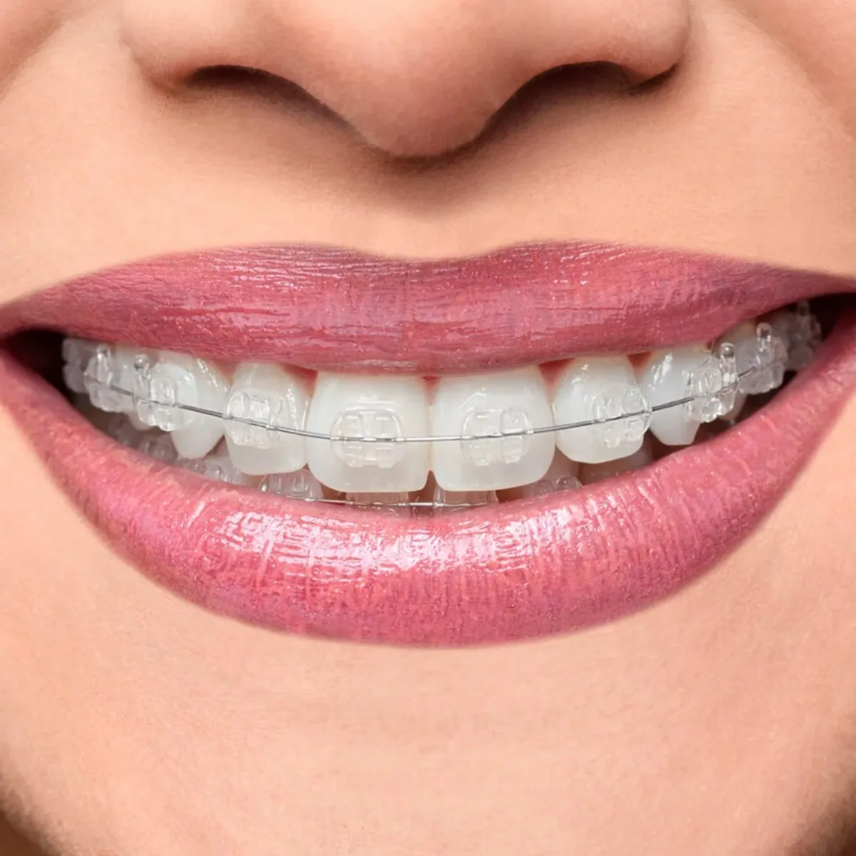 OrthoMetric Iceram -P Polycrystalline Ceramic Bracket Kit