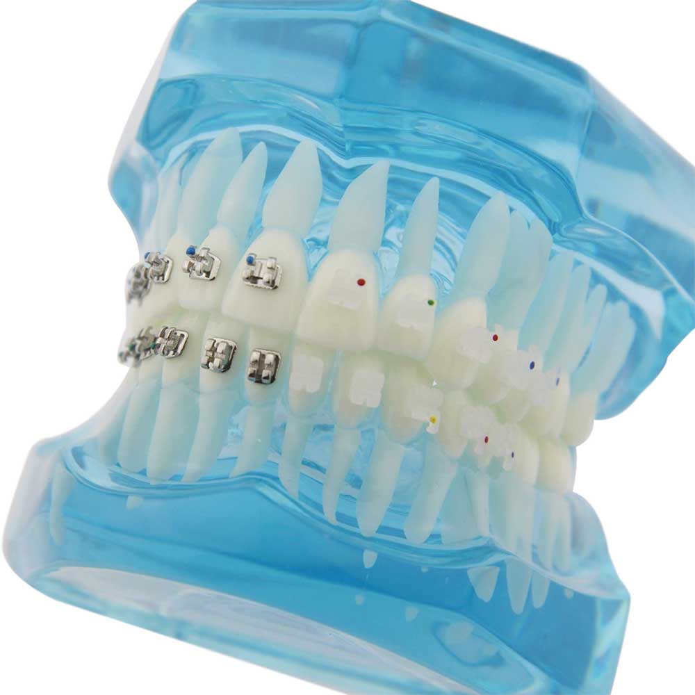iDENTical Half Metal and Half Ceramic Brackets Orthodontic Model ...
