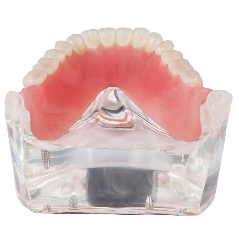 Buy Identical Mandibular Overdenture Model with 4 Implants | Maxillary ...