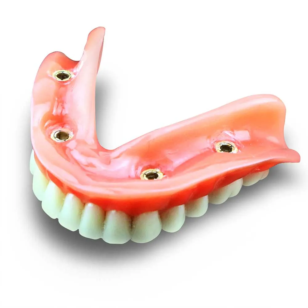 Buy Identical Mandibular Overdenture Model with 4 Implants | Maxillary ...