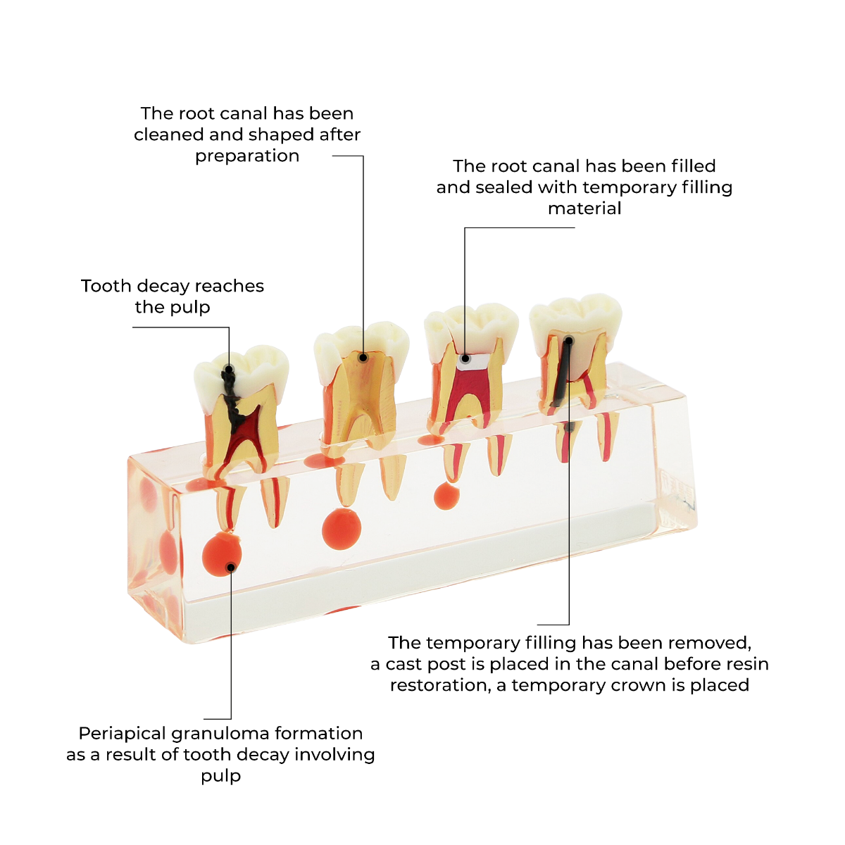 Tooth Model Dental Endodontic Treatment Model Anatomy Of Gums Mandible ...