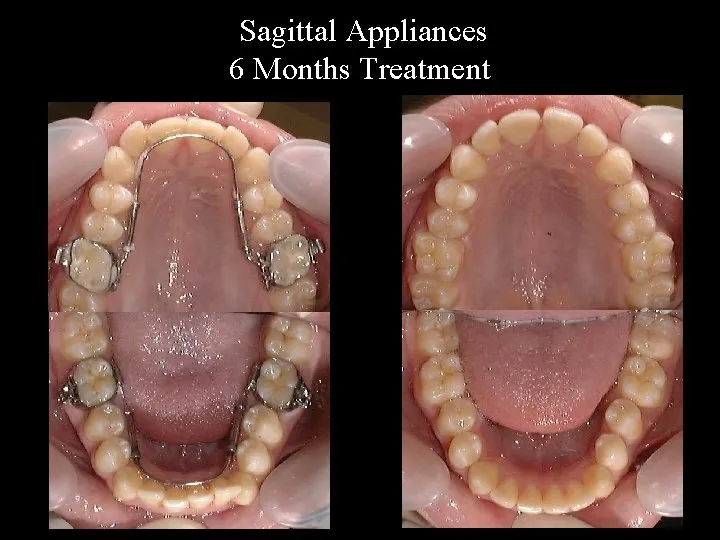 Shop Ortho Organizers Transforce Sagittal Appliance - Best Orthodontic ...