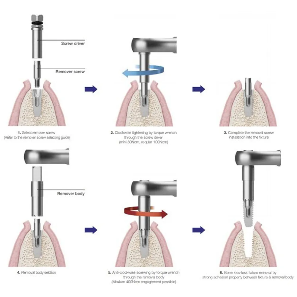 MCTBIO Fixture Remover Kit (FRK-01)