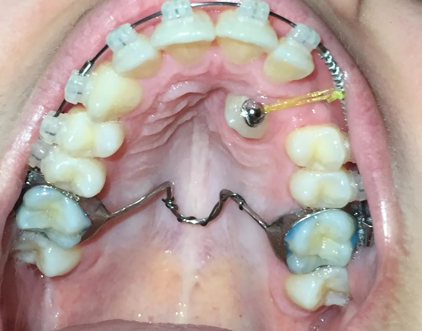 bondable-lingual-buttons-round-2