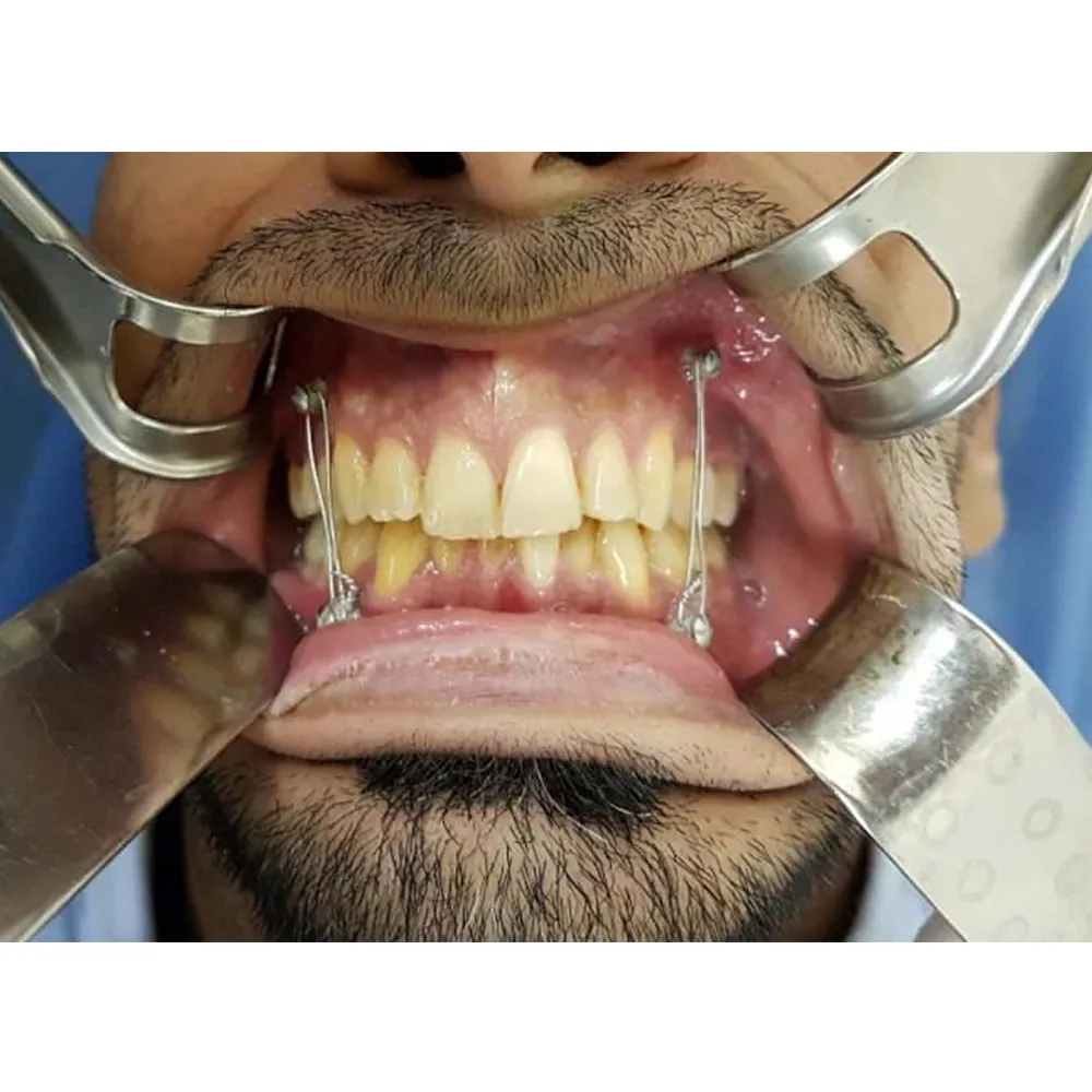 Buy SK Surgicals SS IMF Screws for oral surgery | DentalKar