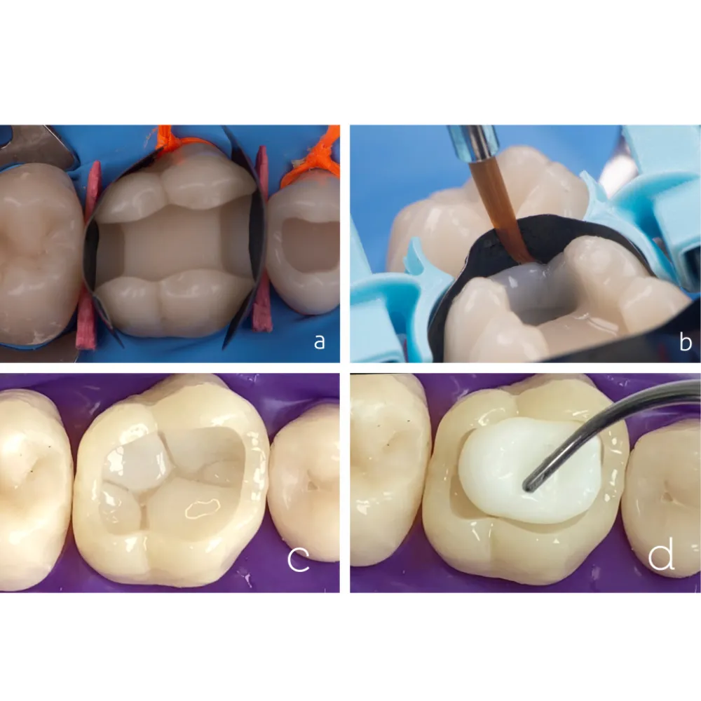 Kids-e-Restore Self Adhesive Flowable GIC