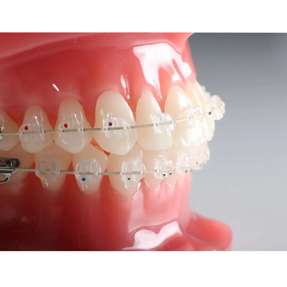 Koden Supreme MBT Ceramic Bracket Kits