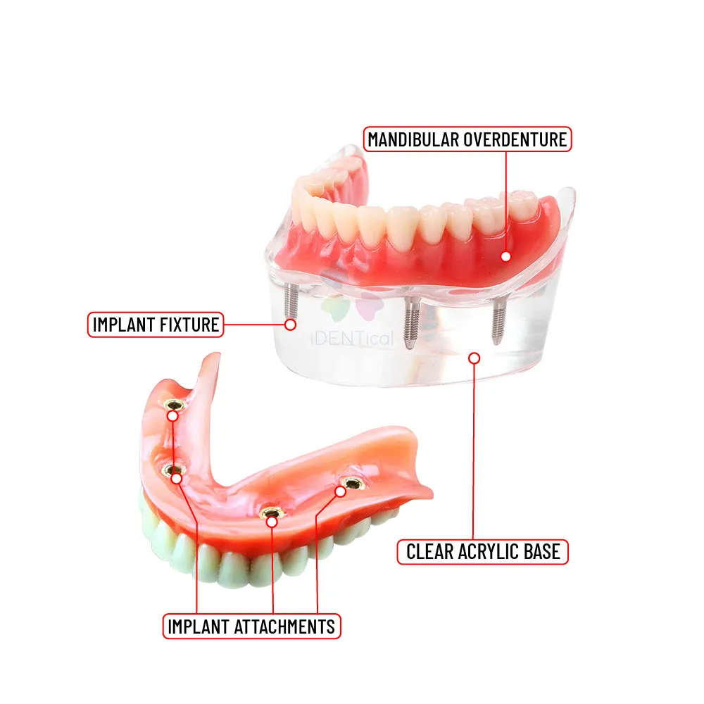 Buy Identical Mandibular Overdenture Model with 4 Implants | Maxillary ...