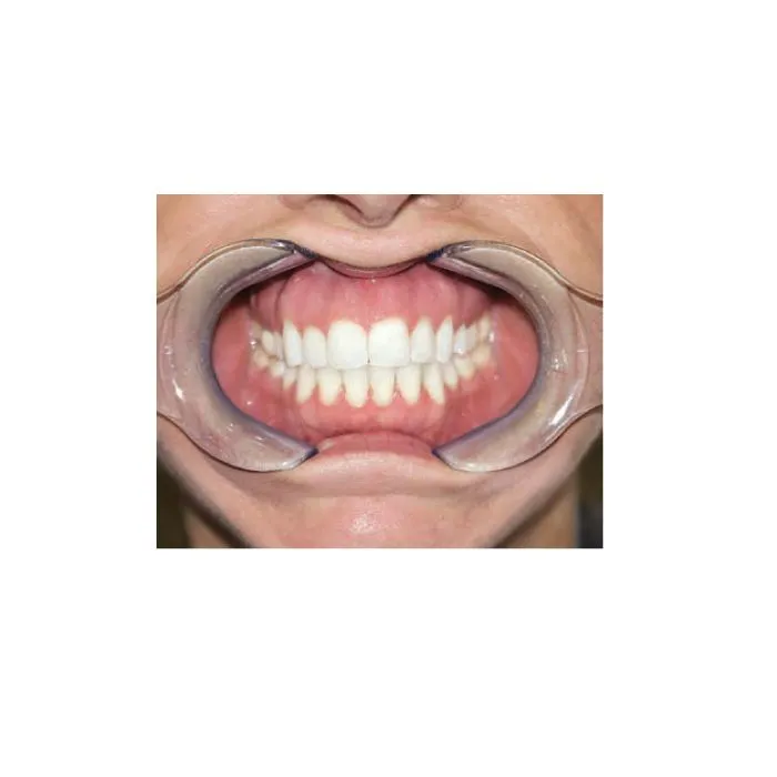 Buy Prime Ortho Lip Retractors Online At Best Price On Dentalkart