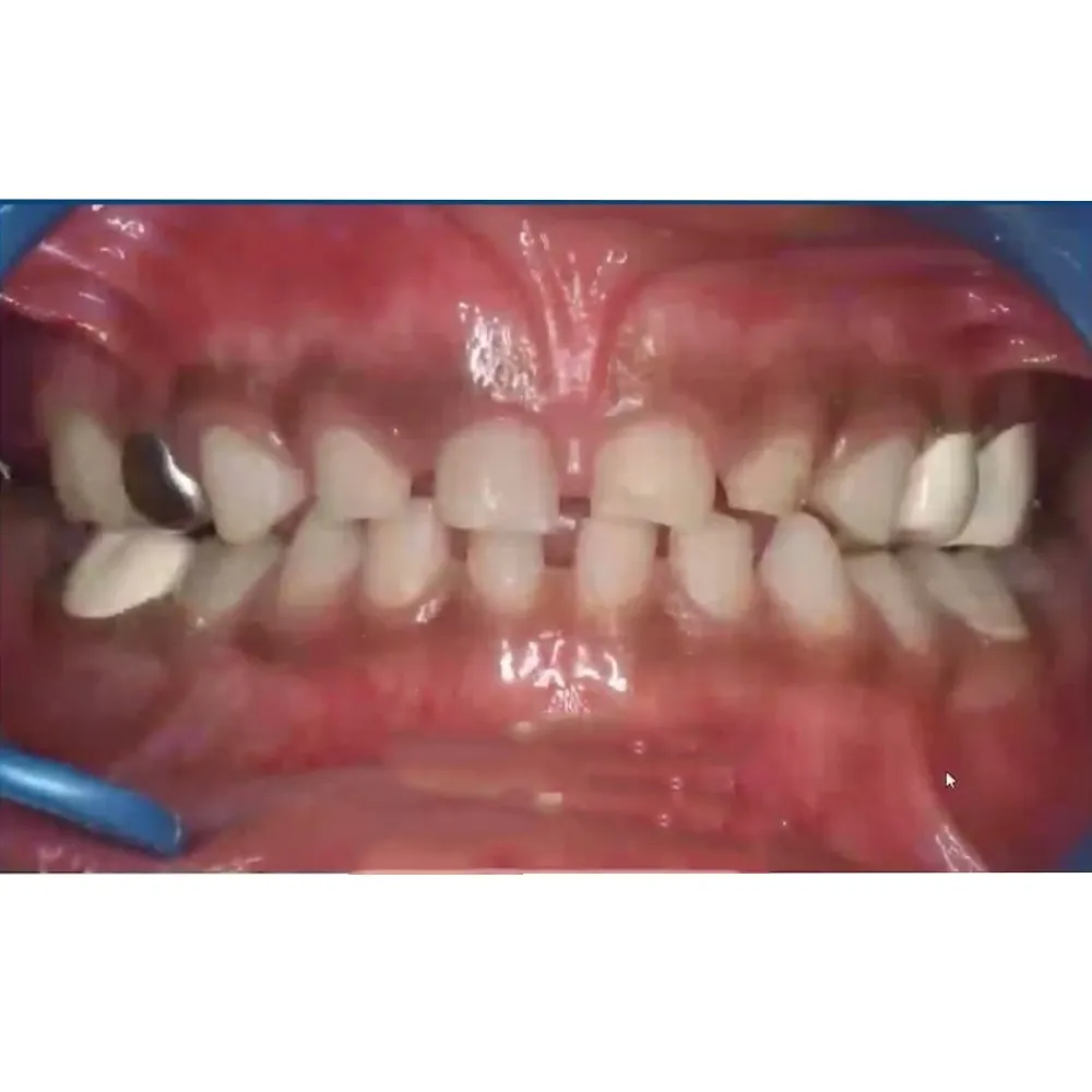 Kids-e-Dental BioFlx Lower Right 1st Molar Crowns Refills