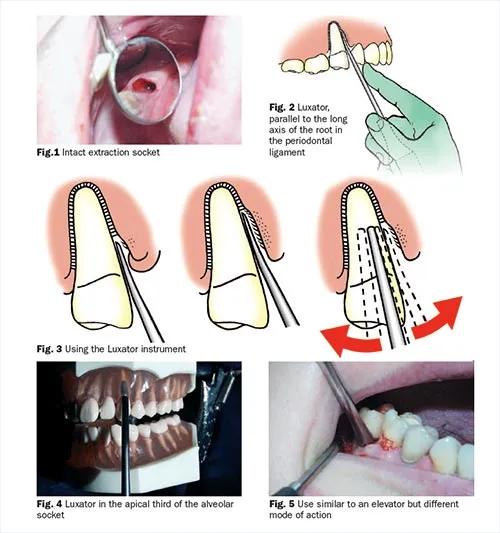 Buy Waldent Luxators | Best Dental Luxator Tools for Extraction ...