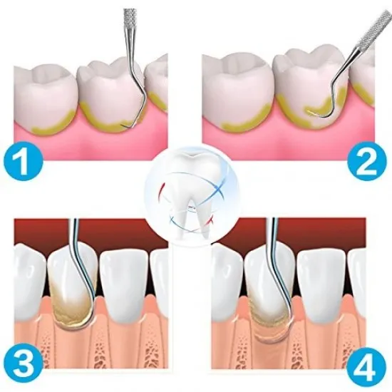 GDC Supra Gingival Scalers S/8 Instruments Kit (SGSP8) Online at Best ...