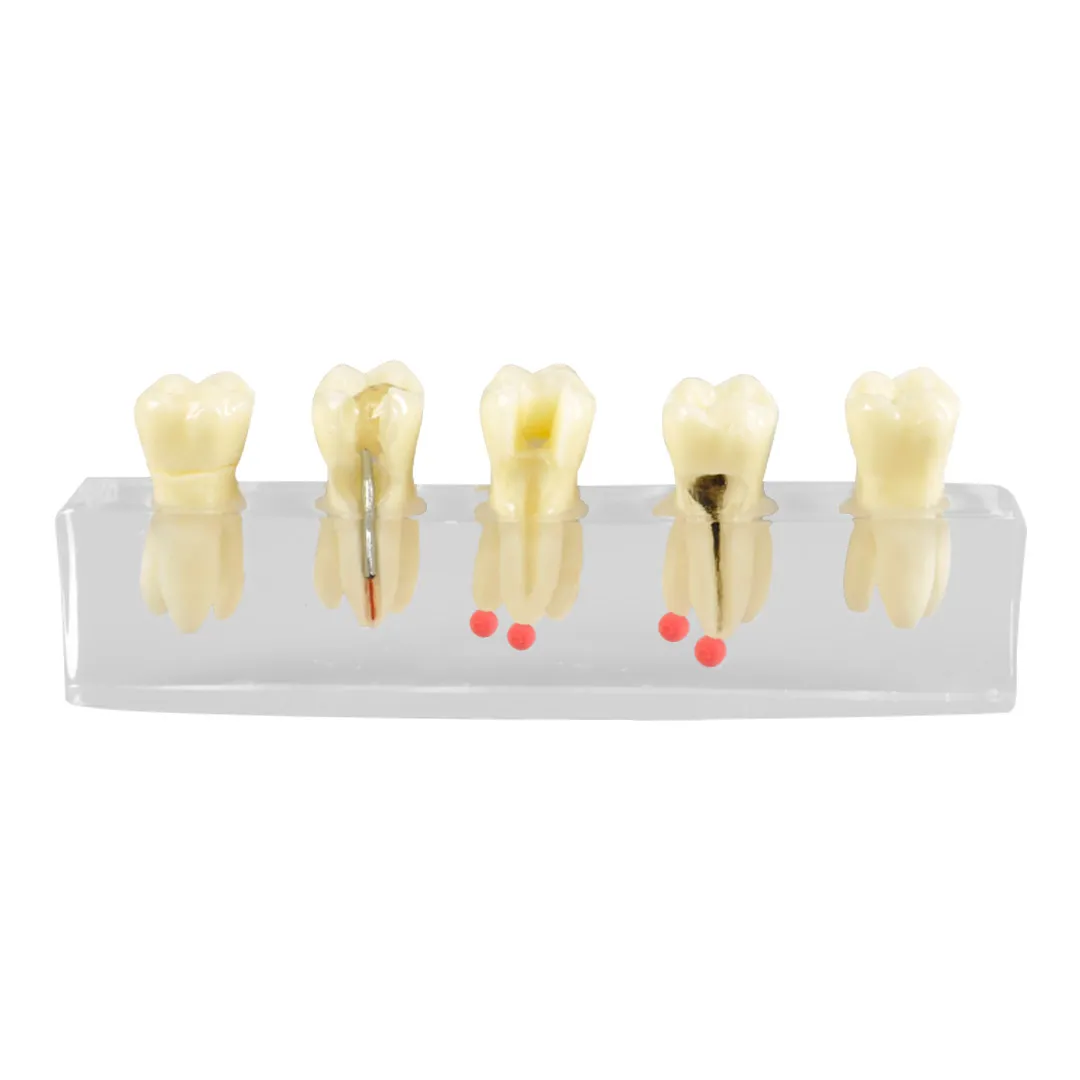 iDENTical Root Canal Model M4012 - Dental Caries & Treatment ...