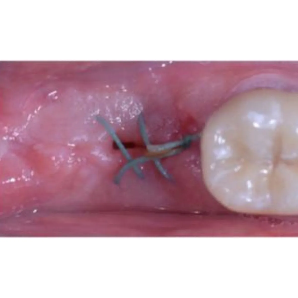 Meril Mericron XL #5-0 Polyester Suture