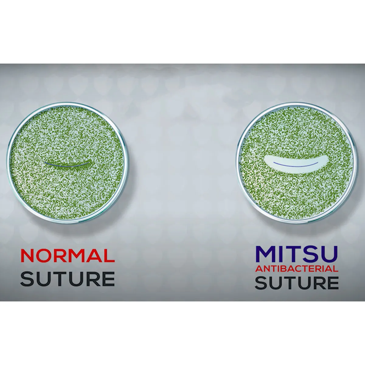 Meril Mitsu AB #4-0 Polyglactin 910 Suture With Triclosan