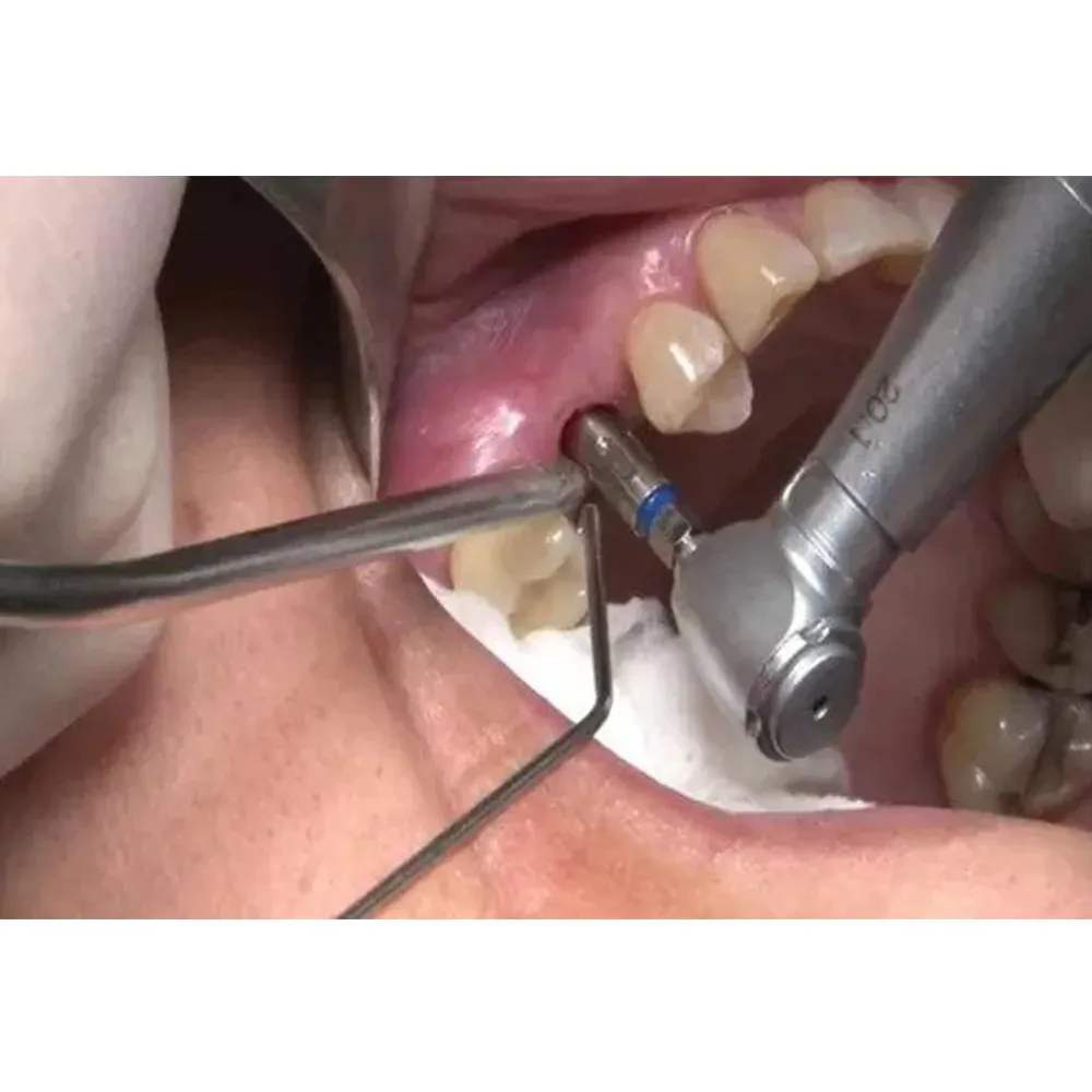 GDC Metal Suction Tip (1.5mm) - Effective Blood and Fluid Evacuation ...